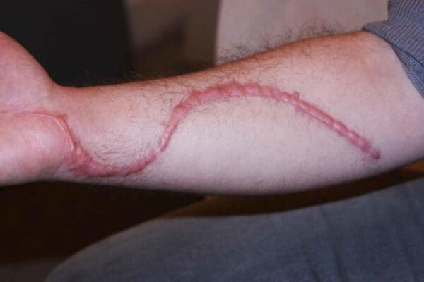 Scars/ Stretch Marks | Scar Treatment by Z-ROC Dermatology